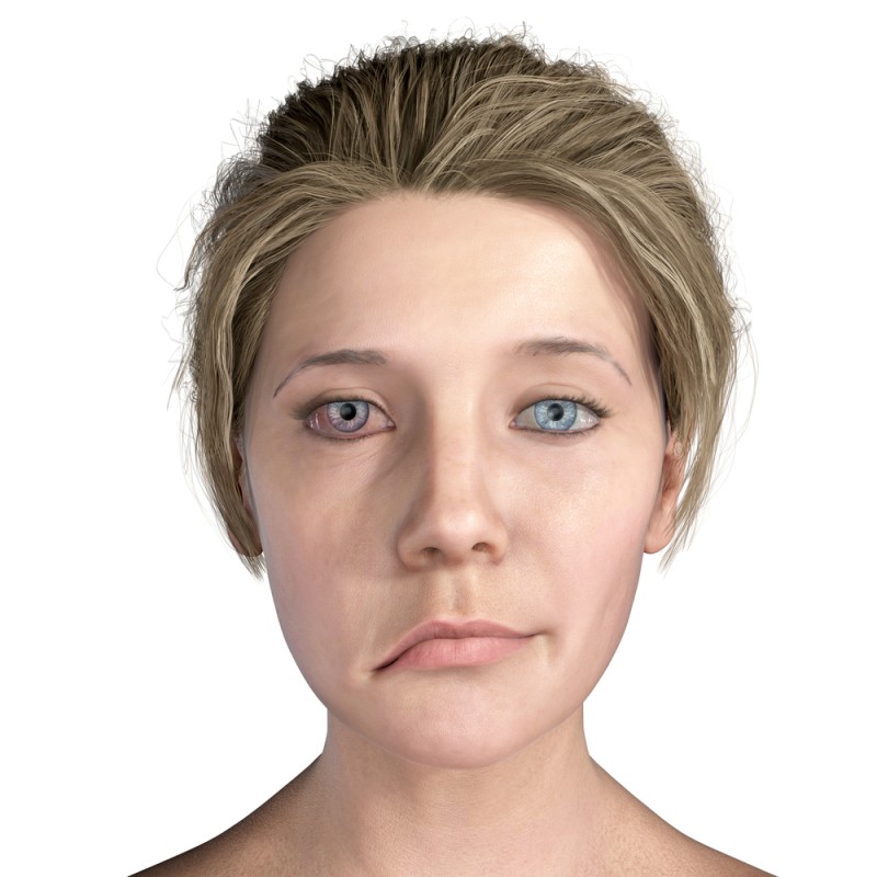 Paralysie faciale : pourquoi ça m'arrive ? - Clinique de Vinci